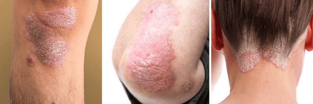 Eczema vs Psoriasis : Apa Yang Sama, Apa Yang Berbeza? - Dr.Ridz SkinLabs