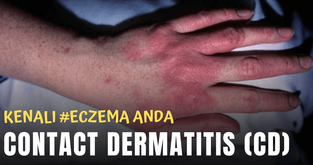 Contact Dermatitis (CD) : Ezema yang anda perlu kenali - Dr.Ridz SkinLabs